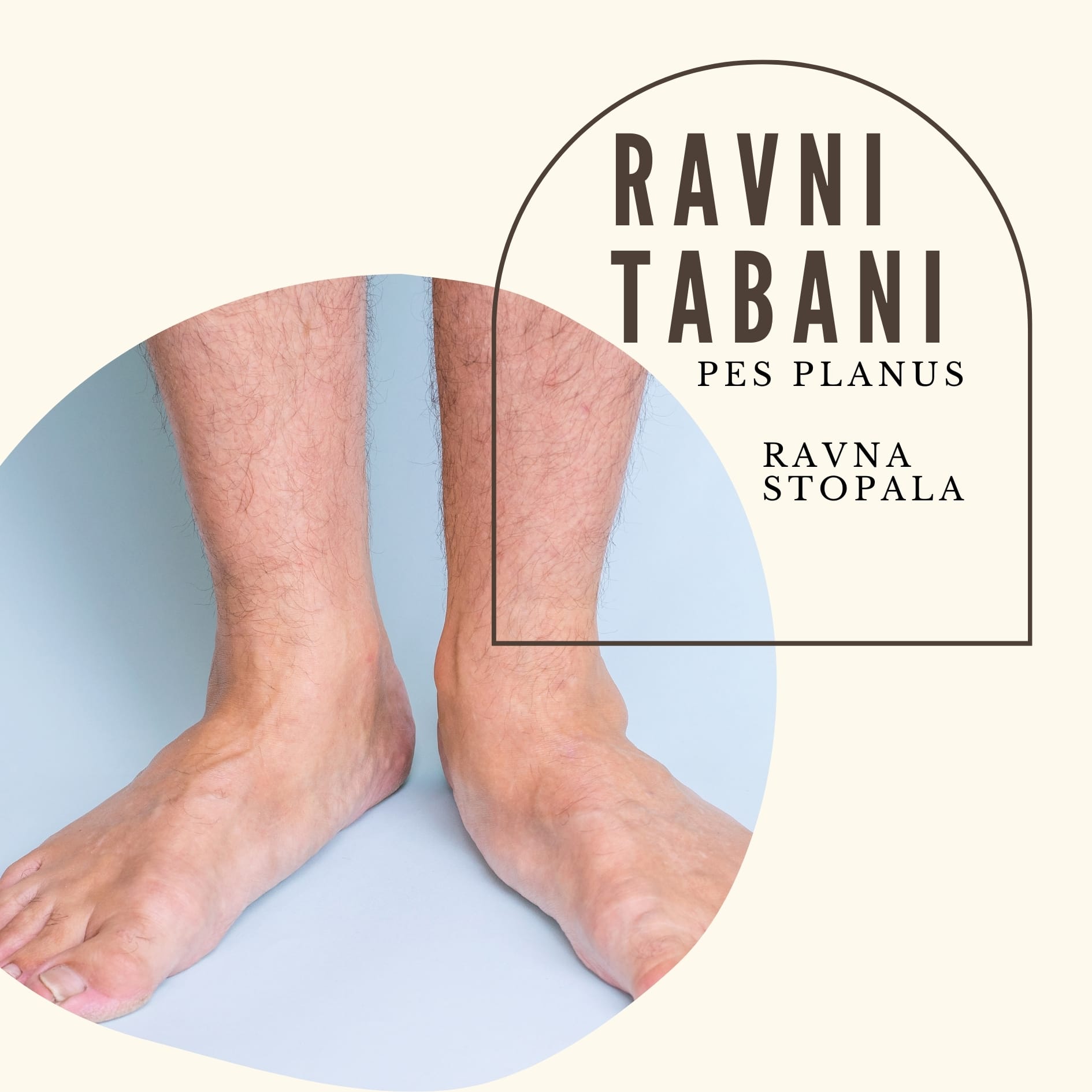 Ravni tabani Ravna stopala Pes Planus i planovalgus