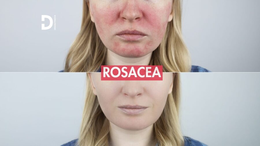 Rozacea – Rosacea - je izazov sa kojim se možemo izboriti