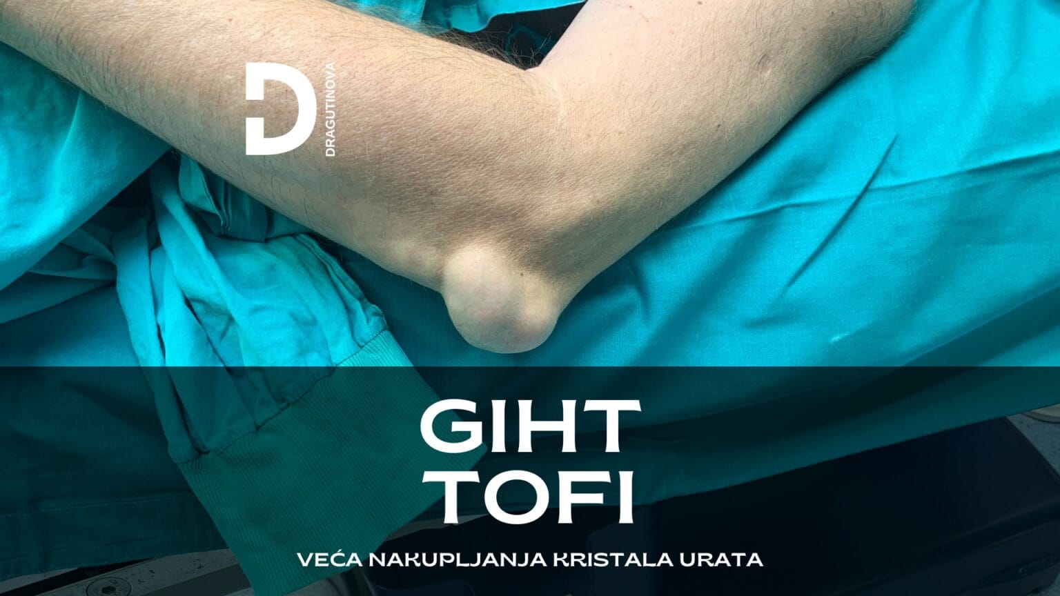 Giht – uzroci, simptomi, dijagnoza i tretman