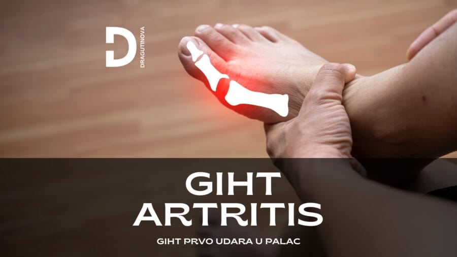 Giht – uzroci, simptomi, dijagnoza i tretman