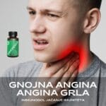 Gnojna angina Uzroci, simptomi i lečenje